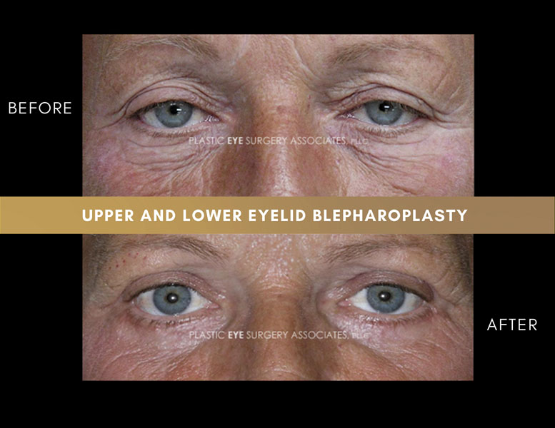 Before & After Gallery - Plastic Eye Surgery Associates