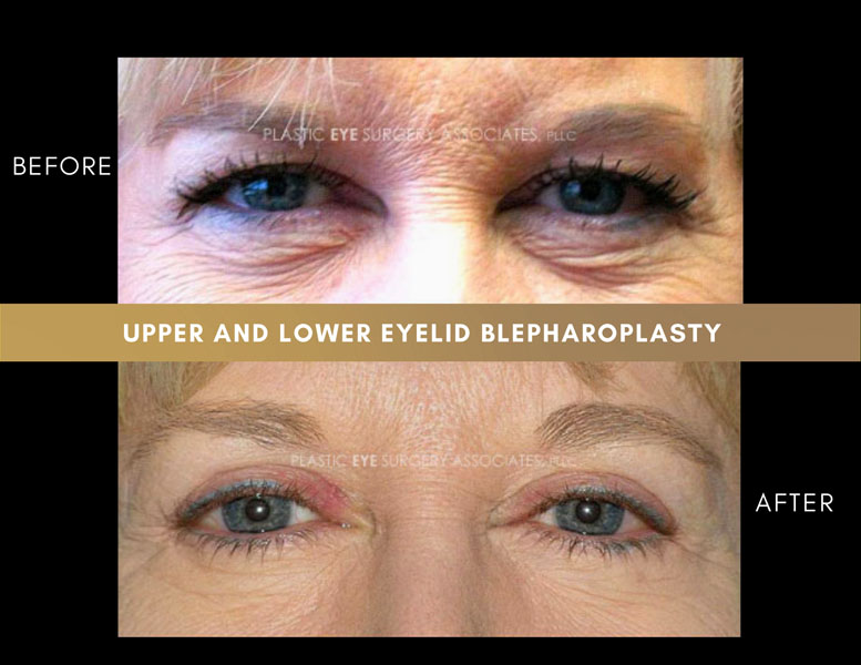 Before & After Gallery - Plastic Eye Surgery Associates