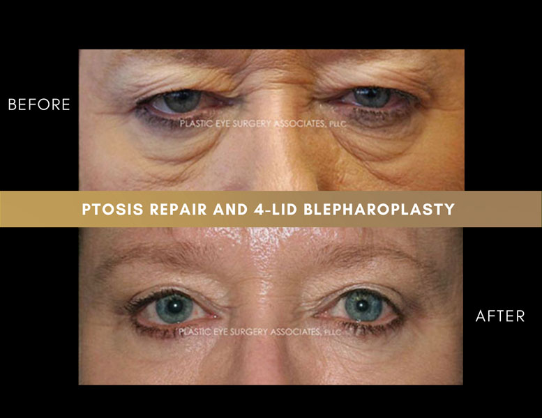 Before & After Gallery - Plastic Eye Surgery Associates